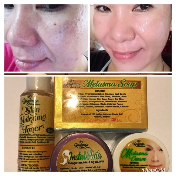 Melasma Remover | Makeup | Melasma Set Antipimples Dark Spot 0 ...